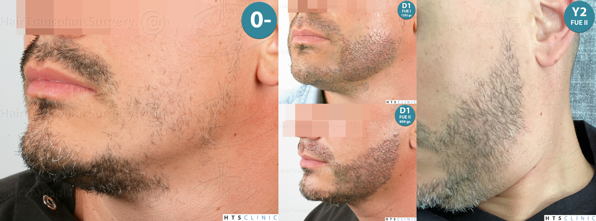 Dr Jean Devroye Hts Clinic 2191 Fue 1292 899 Beard